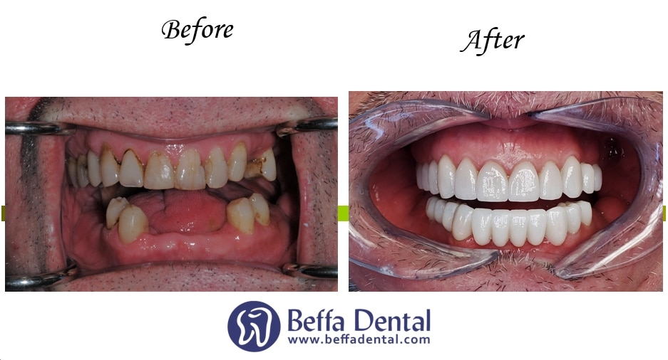 New Smiles | Smile Transformations | Beffa Dental
